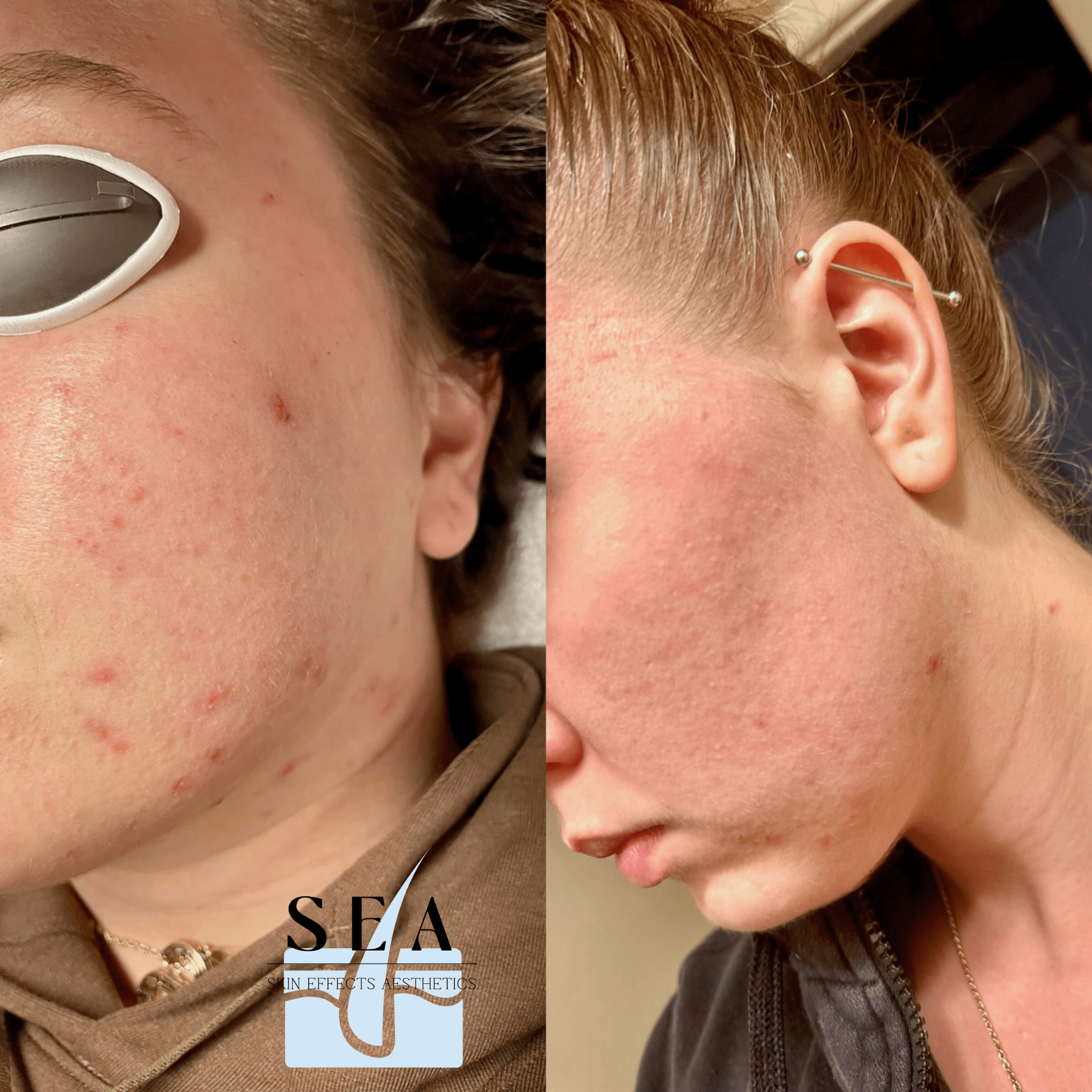 Laser Acne Treatment – Skin Effects Aesthetics